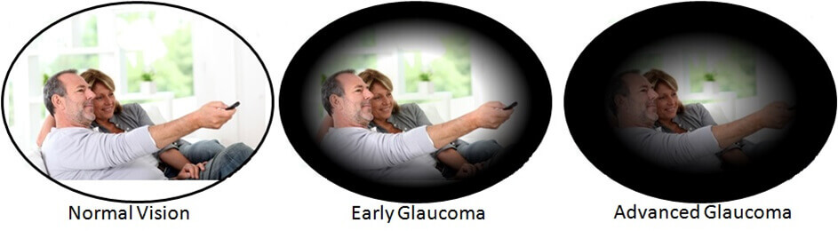Glaucoma Management Kirby Eye CenterKirby Eye Center